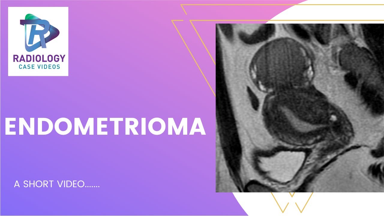 Endometrioma MRI, T2 Shading phenomenon #Umamaheshwar Reddy. V - YouTube