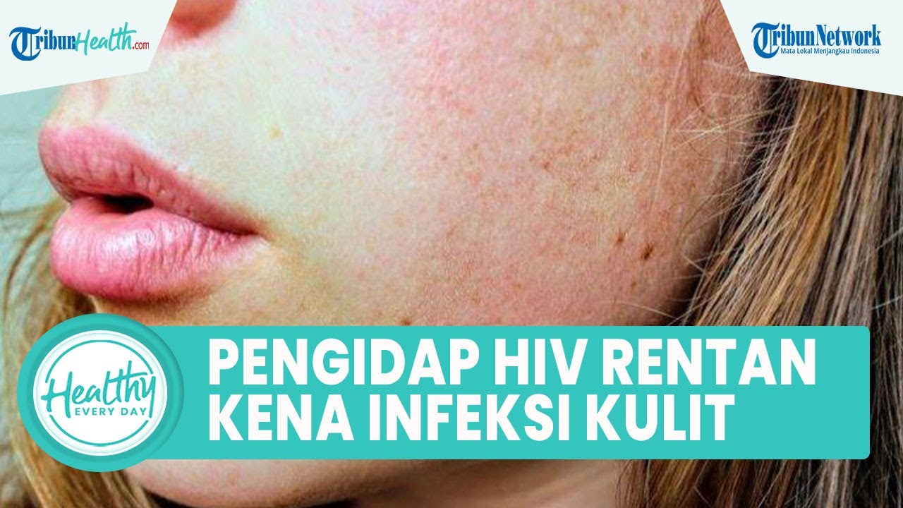 Waspadai Pengidap HIV Rentan Terkena Infeksi Jamur Kulit, Begini ...
