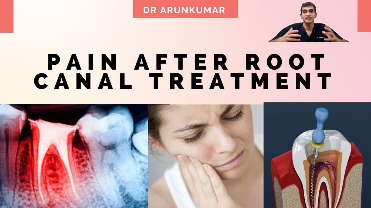 Is it Normal to have pain after Root Canal Treatment? Dr Arunkumar ...