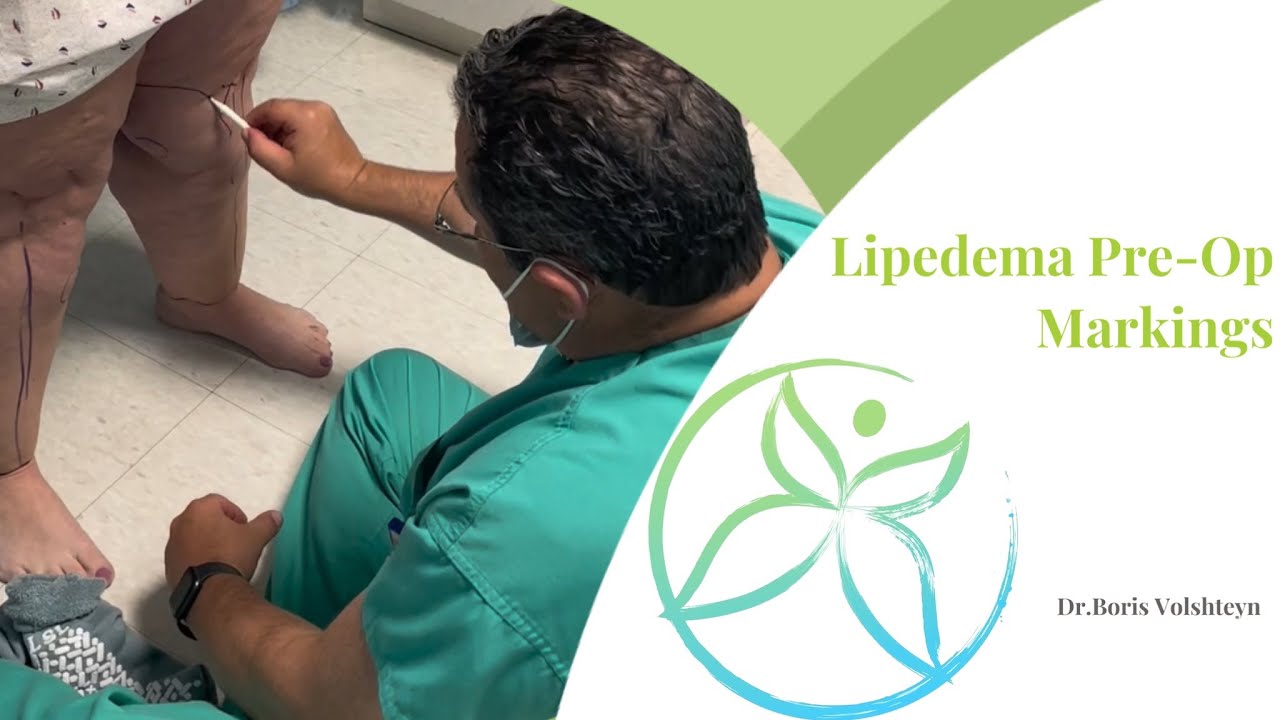 Preoperative Markings for Lipedema Liposuction - Lower Extremities - Dr ...