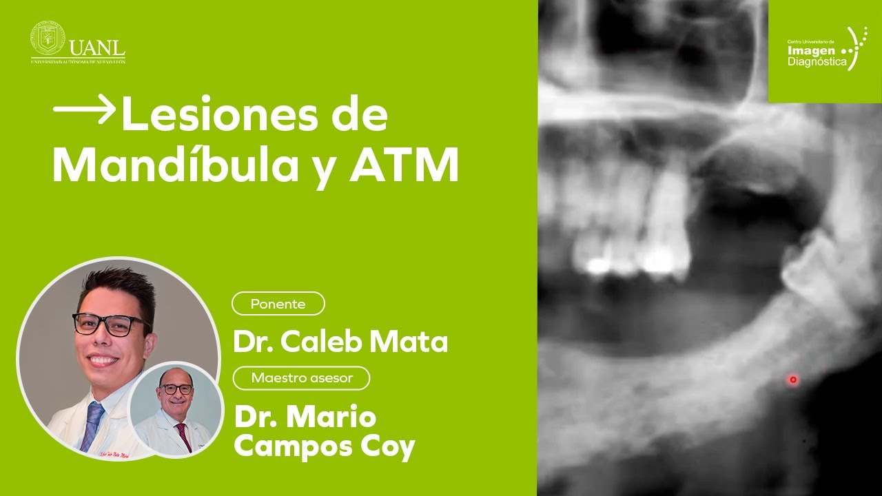 Lesiones de Mandíbula y ATM por el Dr. Caleb Mata. - YouTube