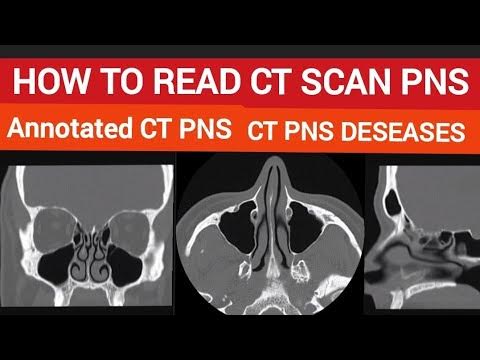 How to read CT Scan PNS | Annotated CT Scan PNS | #radiography #CTPNS #ctscan #anatomy - YouTube