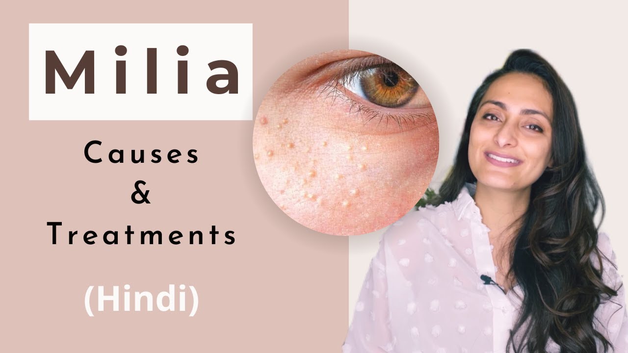 Milia | milia क्यूँ होते है । मिलिया का इलाज। बदने से कैसे रोके। त्वचा ...