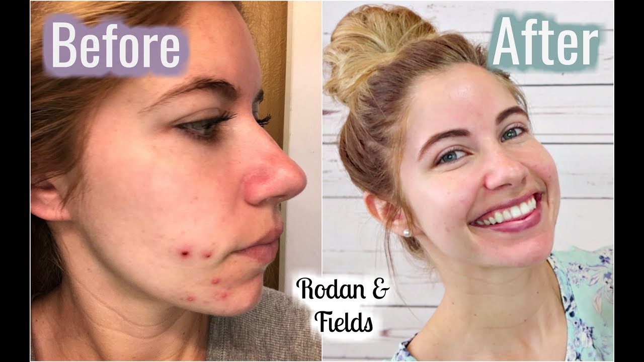 RODAN & FIELDS UNBLEMISH REGIMEN: 12 WK RESULTS! | Emily Inman - YouTube