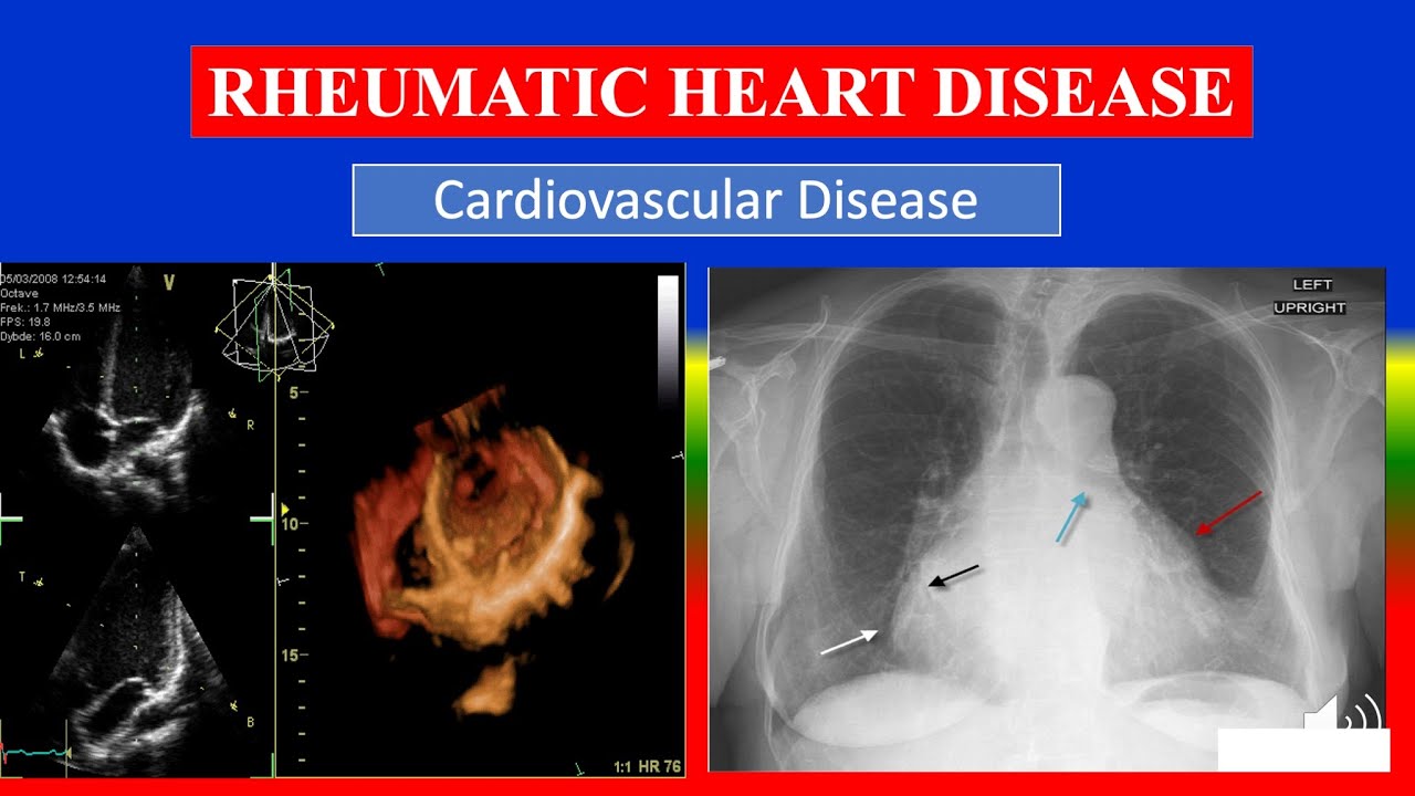 RHEUMATIC HEART DISEASE - Definition, types, causes, pathophysiology ...