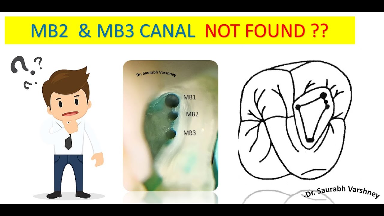 Locate MB2 & MB3 canals easily - YouTube