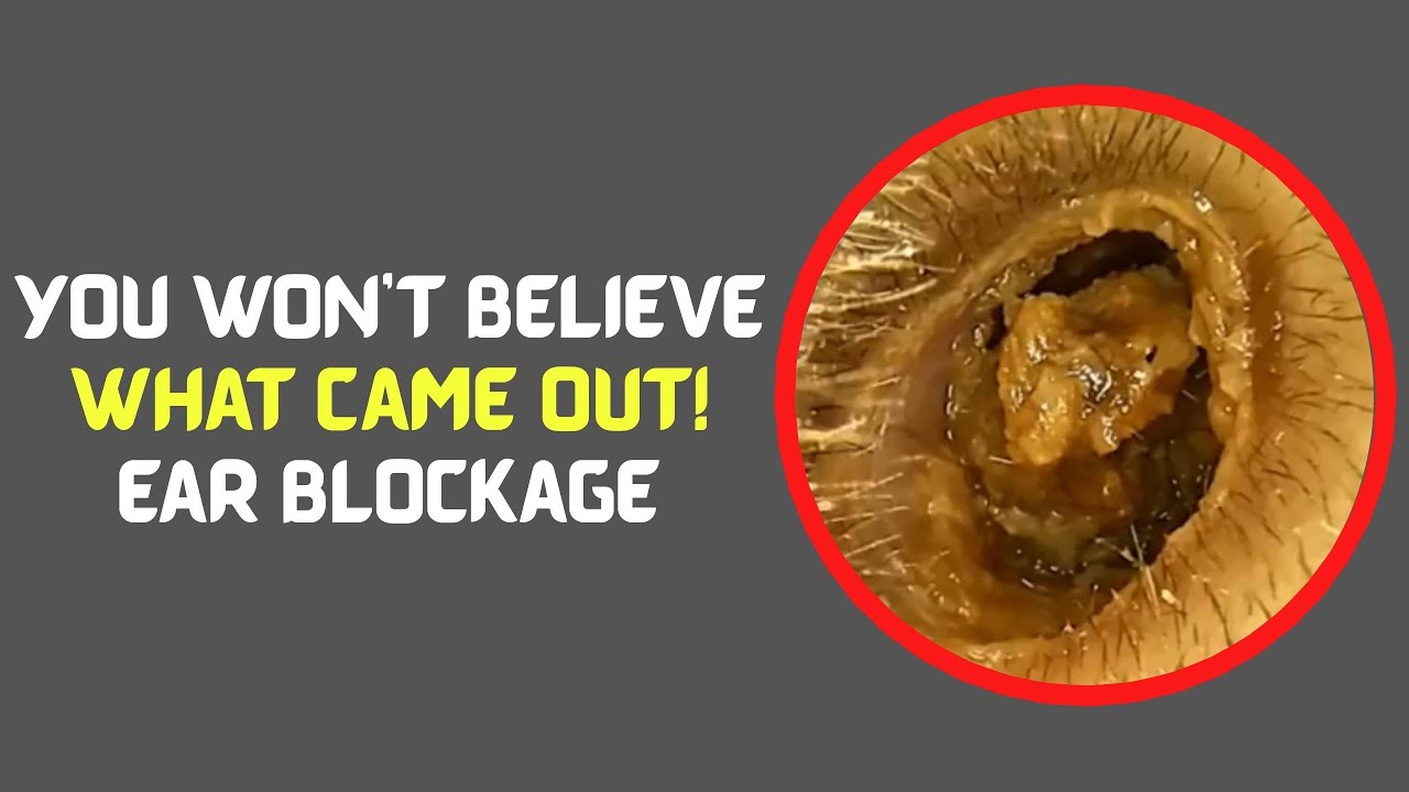 Satisfying Ear Wax Removal | Deep Ear Cleaning ASMR for Relaxation ...