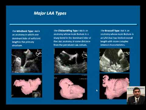 WATCHMAN LAA Closure Technology Implant Procedure - YouTube