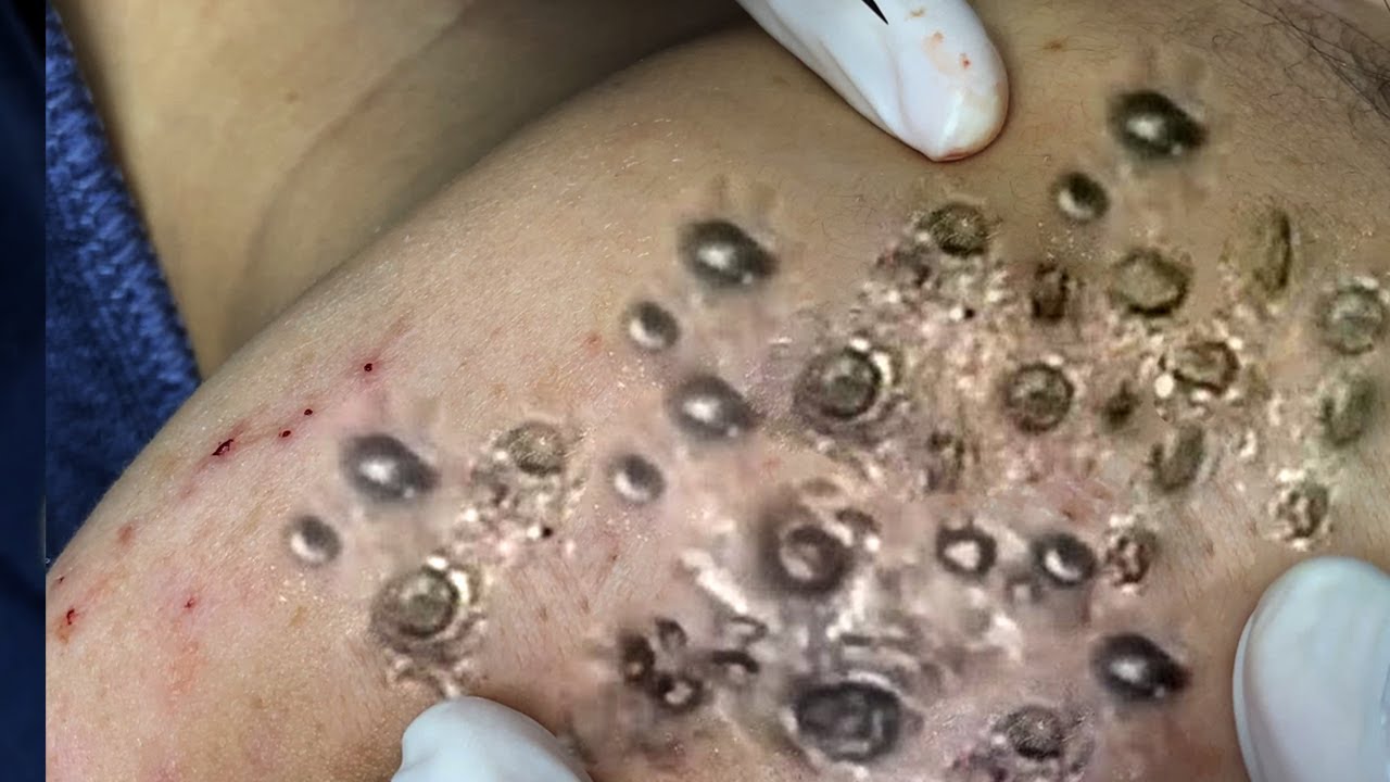 𝐌𝐨𝐬𝐭 𝐒𝐚𝐭𝐢𝐬𝐟𝐲𝐢𝐧𝐠 𝐏𝐢𝐦𝐩𝐥𝐞𝐬 𝐑𝐞𝐦𝐨𝐯𝐚𝐥 𝐀𝐭 𝐇𝐨𝐦𝐞 #1653 - YouTube