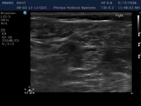 Ultrasound Guided Obturator Nerve Block, Rabah et al.WMV - YouTube