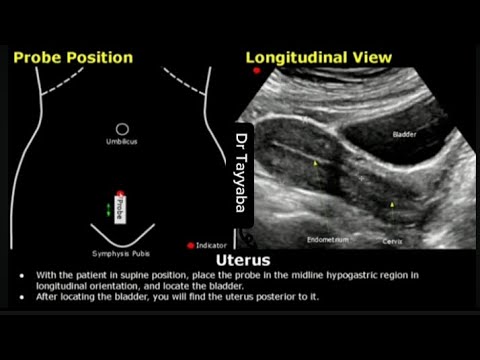Uterus & Ovaries Ultrasound Probe Positioning | Transducer Placement ...
