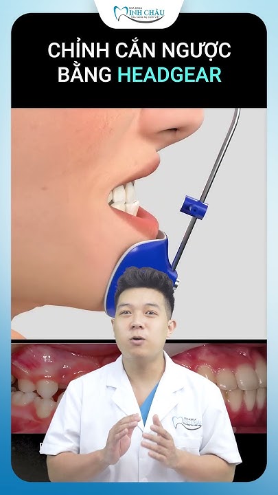 Chỉnh Khớp Cắn Ngược Bằng Khí Cụ Headgear | Nha Khoa Minh Châu - YouTube