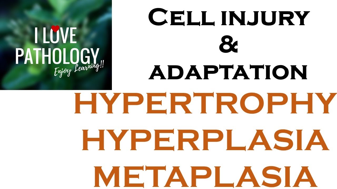 Cell Adaptations: pathology:HYPERTROPHY HYPERPLASIA AND METAPLASIA ...
