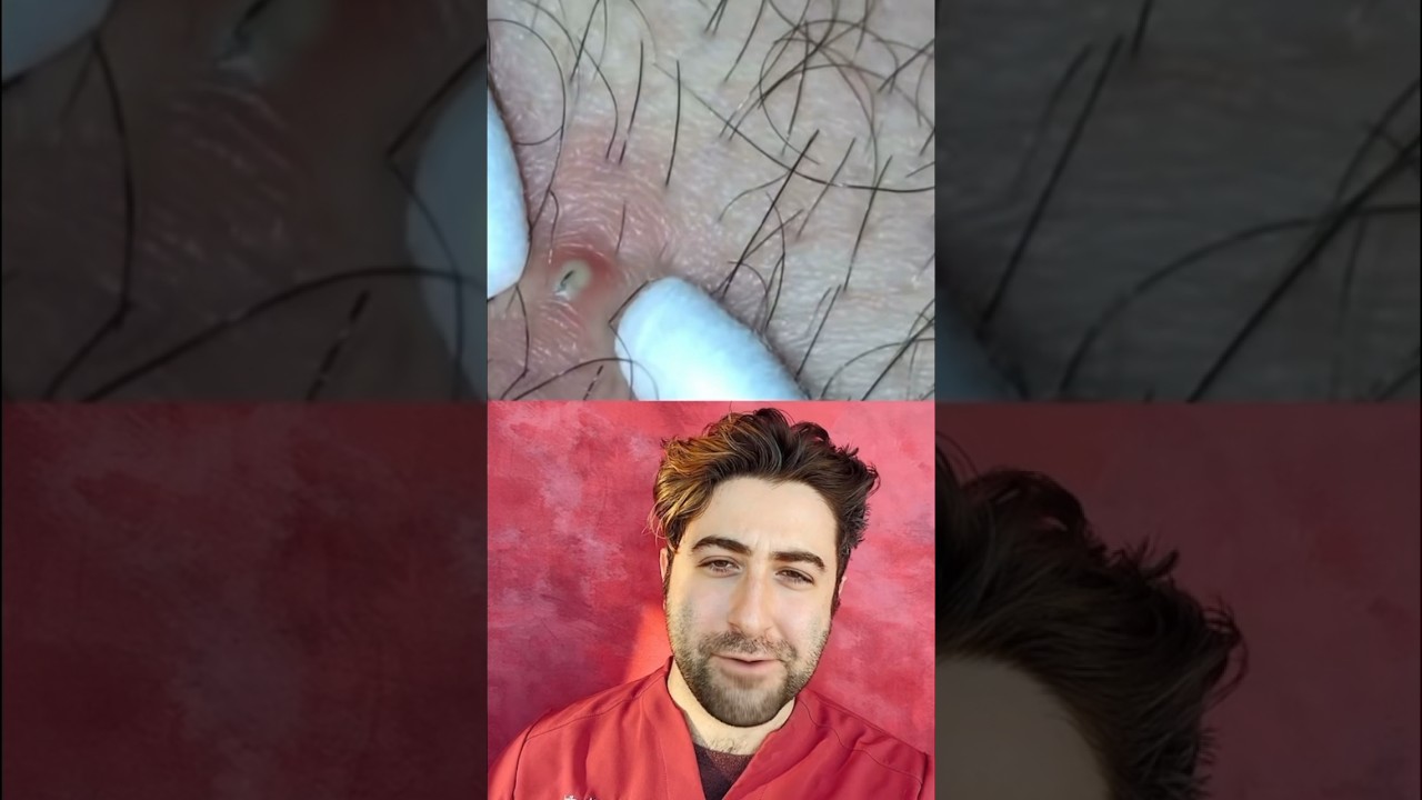 Perfect pustule popped with double q tip method - YouTube