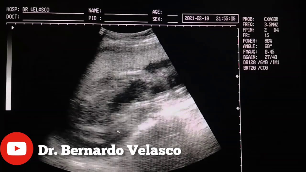 Feto De 26 Semanas Ultrasound Of A Fetus At 26 Weeks Stock Photo