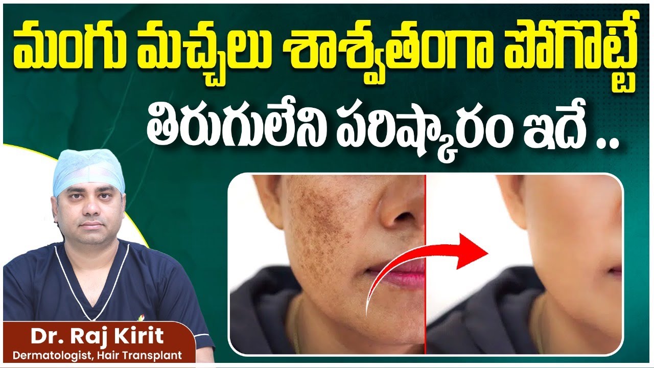 Best Treatment For Melasma On Face | Best Skincare For Melasma ...