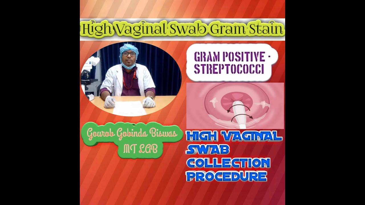High vaginal swab (HVS) Wet preparation under Microscope. Gram Positive ...