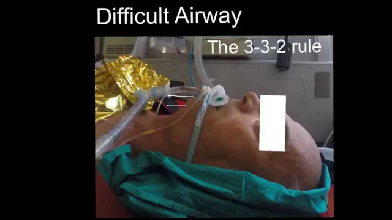 The Difficult Airway The 3 3 2 Rule YouTube