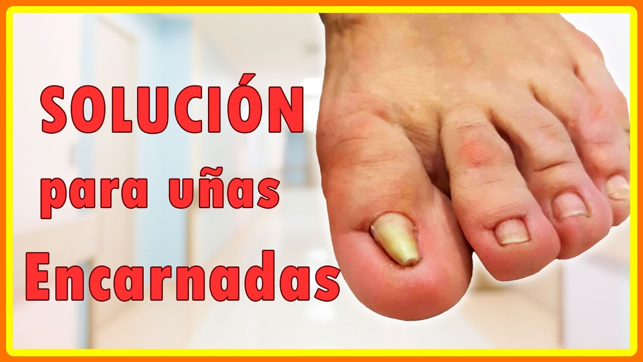 ¿UÑAS ENCARNADAS ? Así vuelven a su forma original - YouTube