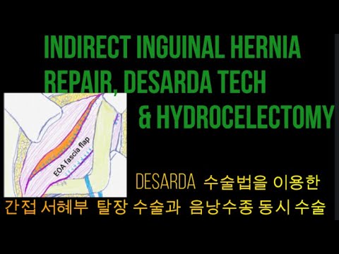 Desarda 수술법을 이용한 간접서혜부 탈장수술과 음낭수종 동시수술(Indirect inguinal hernia repair ...