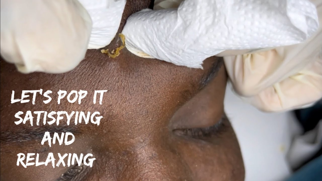 RELAXING AND SATISFYING PIMPLE EXTRACTION SKINCARE ROUTINE. # ...
