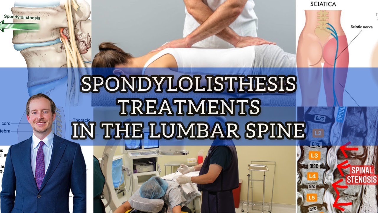 Spondylolisthesis Treatment Options in the Spine - YouTube