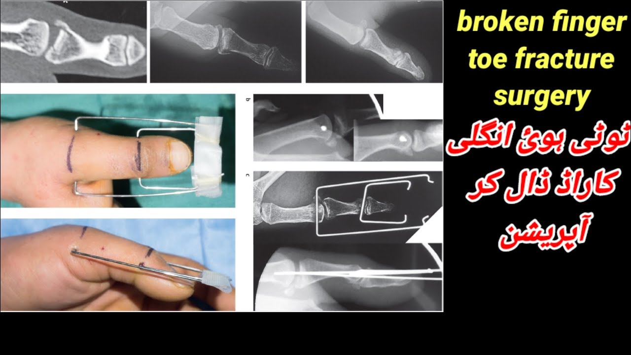 finger fracture surgery/ broken finger surgery with raad / fracture ...
