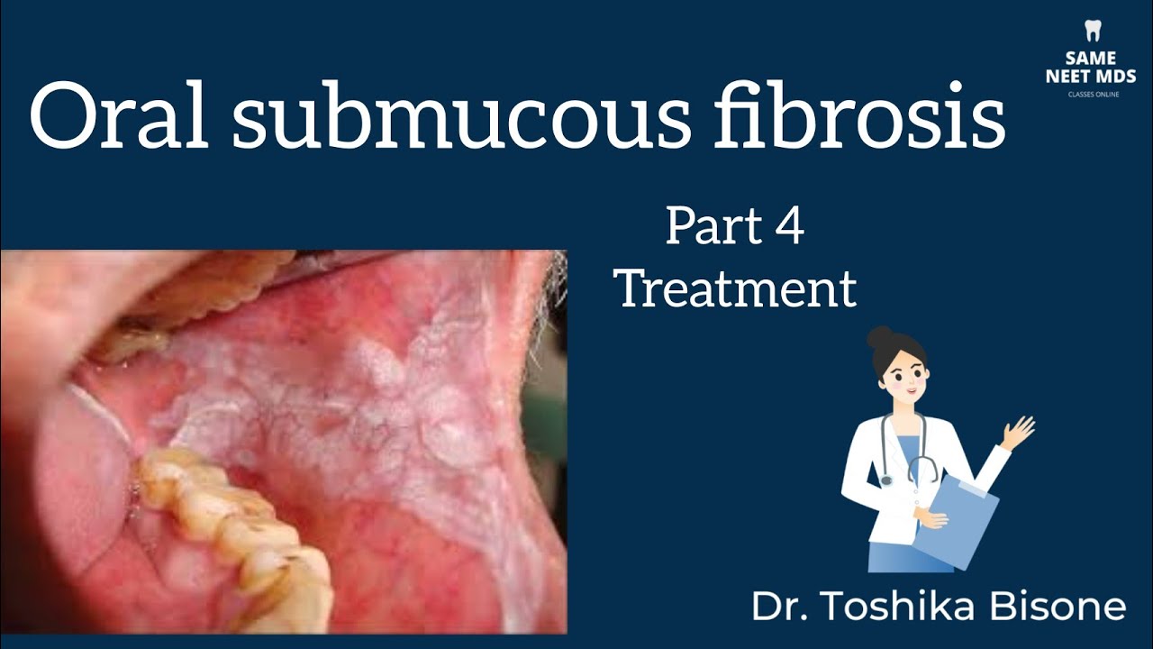 Treatment and Management of OSMF | Oral submucous fibrosis | Part 4 ...