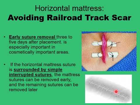 11 horizontal Mattress Sutures - YouTube