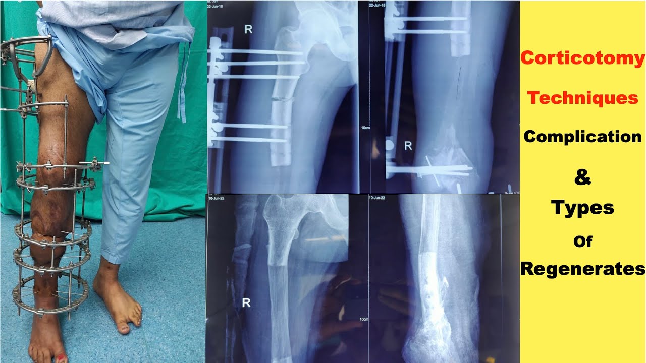 Corticotomy Techniques, Complications and Typeof Regenerates - YouTube