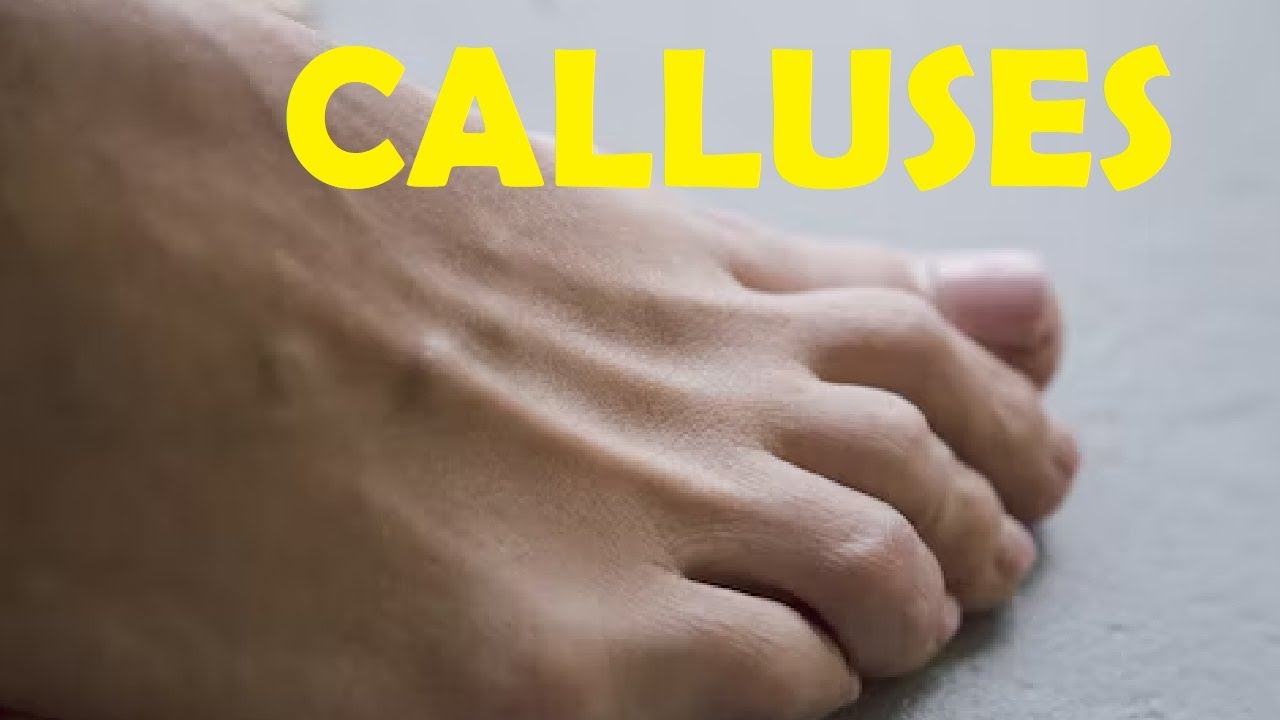 how to get rid of calluses on your feet tutorial - YouTube
