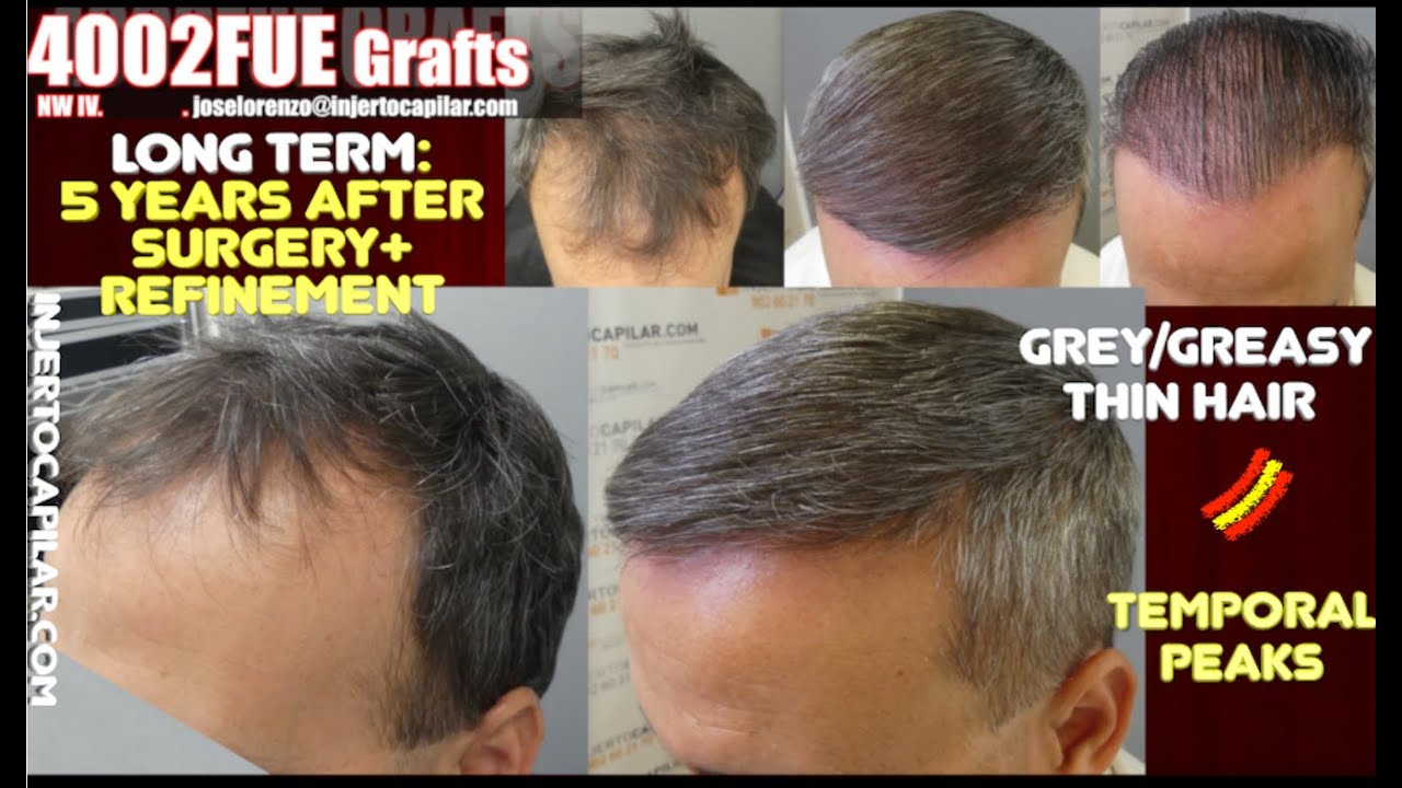 4002Grafts. Long term: 5 years after best outcome +refinement.NW IV ...
