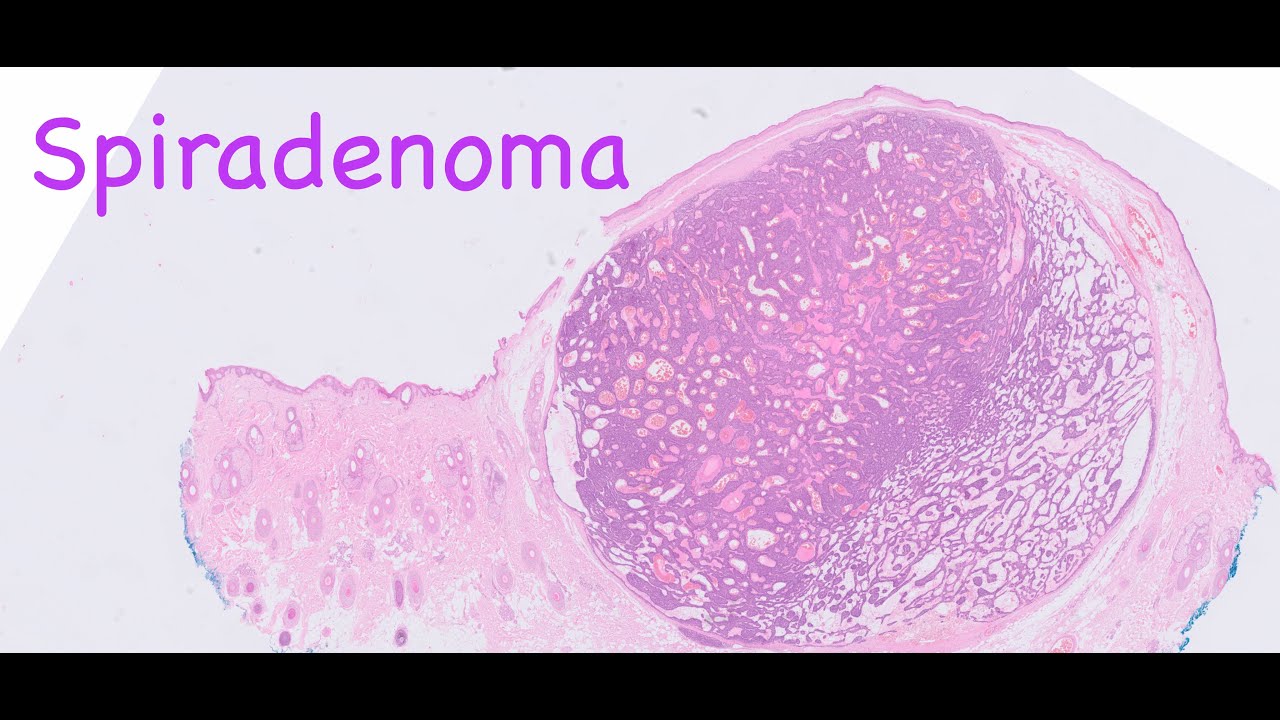 Spiradenoma - YouTube