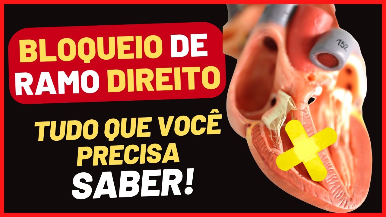 BLOQUEIO COMPLETO e INCOMPLETO do RAMO DIREITO no ECG | O que é ...
