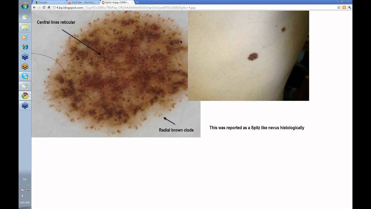 Dermoscopy Made Simple - Spitz nevi - YouTube