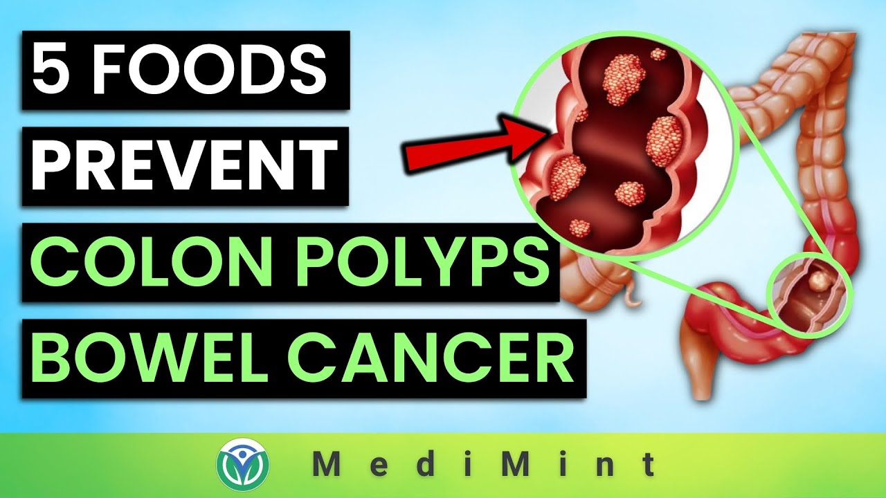 Top 5 Foods To Prevent Colon Polyps Bowel Cancer Add Foods To Limit