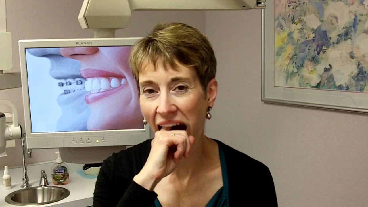 Invisalign aligner removal.MOV - YouTube