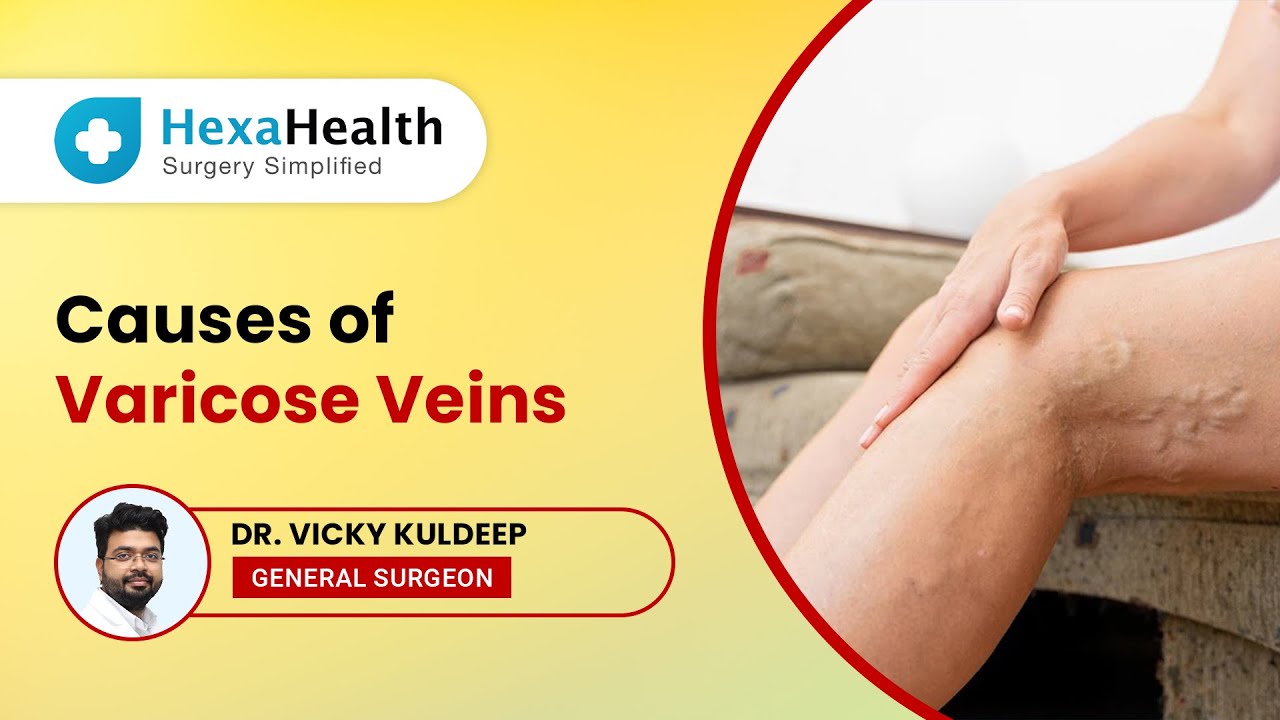 What are the causes and risk factors for varicose veins? || HexaHealth ...