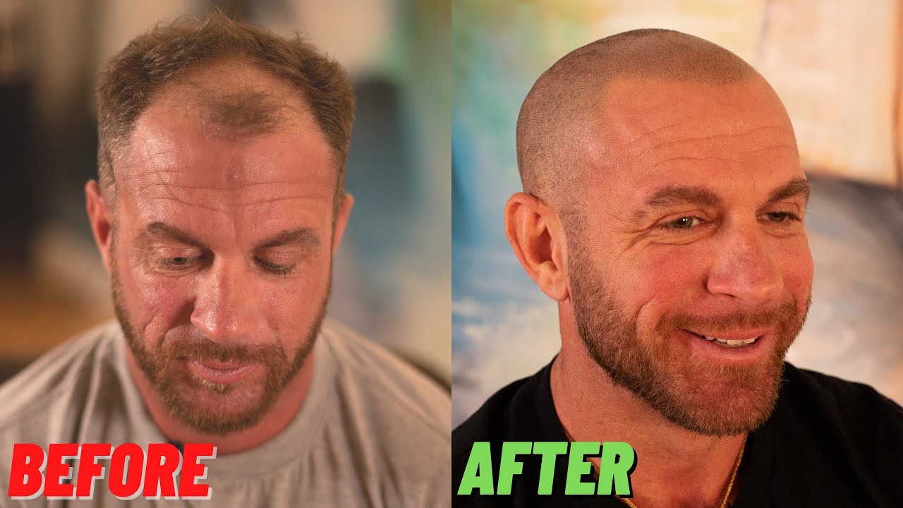 AMAZING RACE Star gets SCALP MICROPIGMENTATION - YouTube