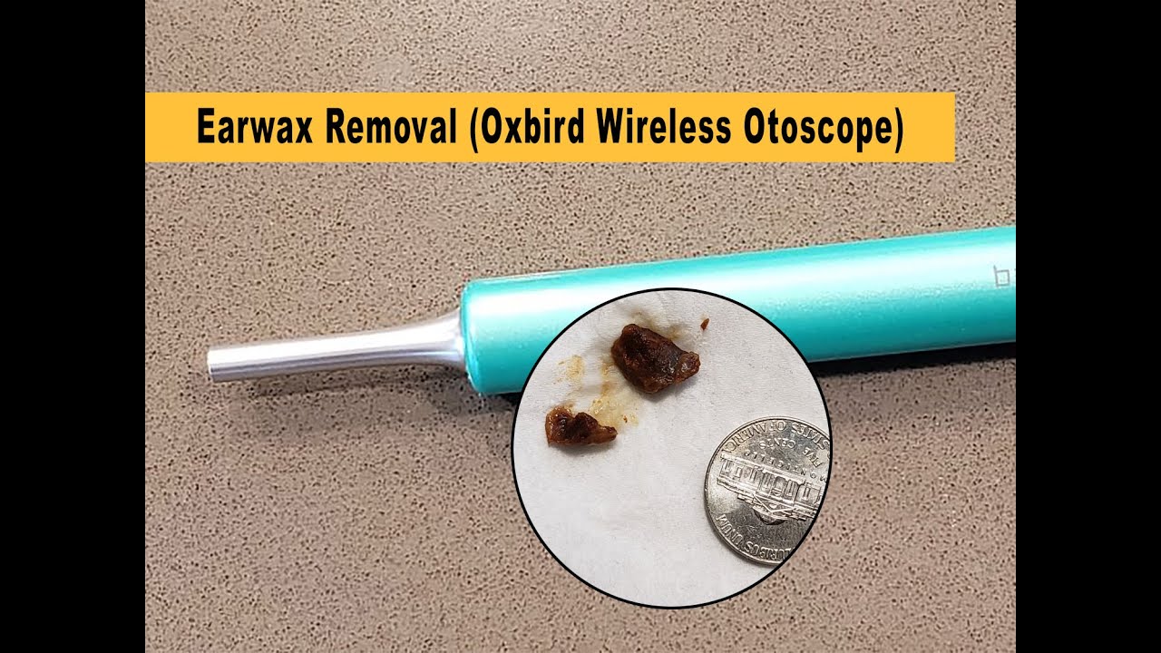 Earwax removal (Oxbird Wireless Otoscope) - YouTube
