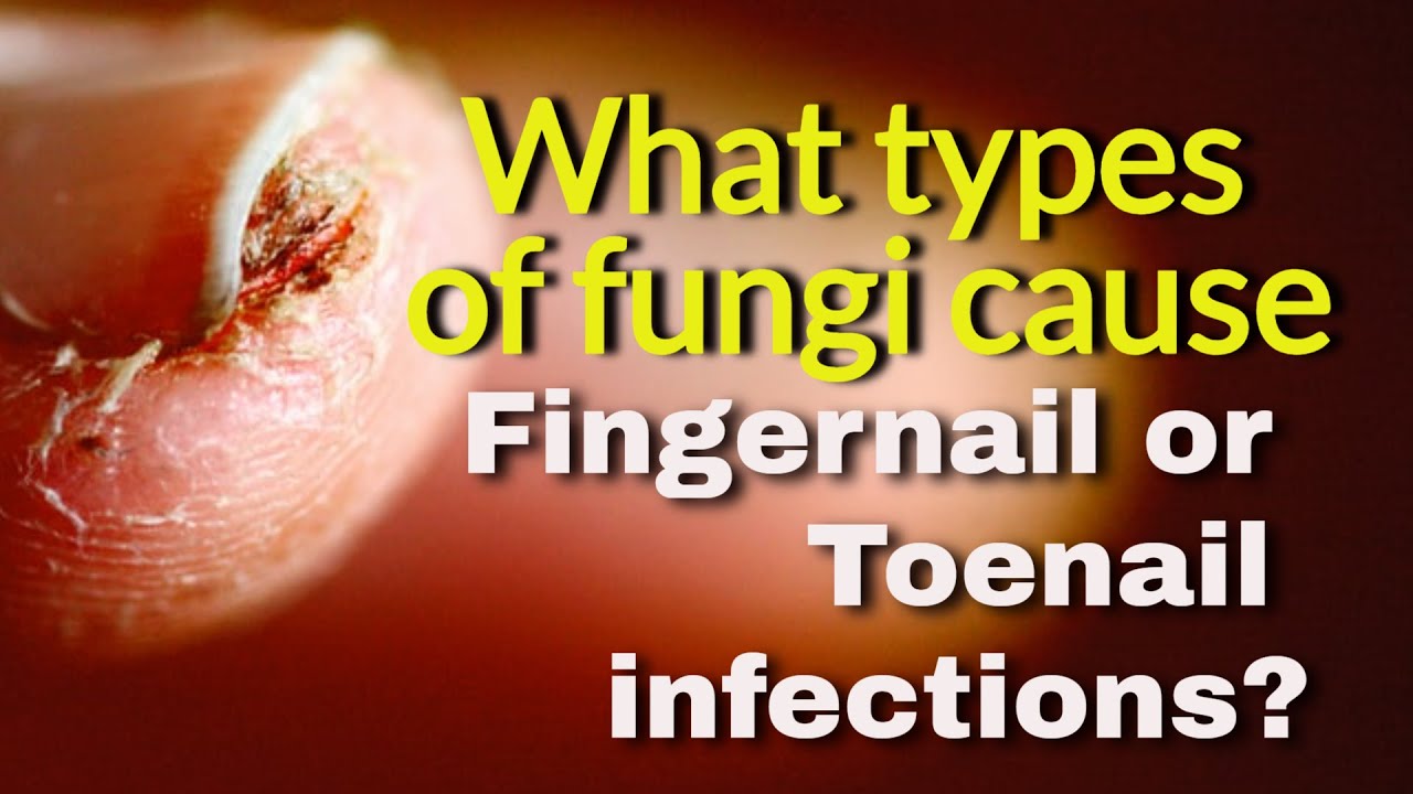 What types of fungi cause Fingernail Infections? - YouTube