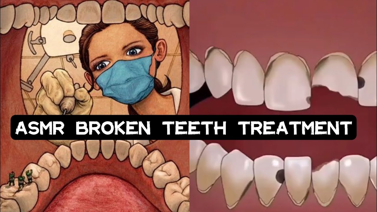 {ASMR Animation} Broken Teeth Treatment | filling, cleaning and scaling ...