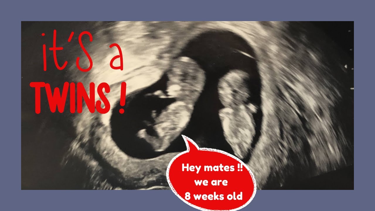 Active twins at 8 weeks old | Ultrasound Case - YouTube