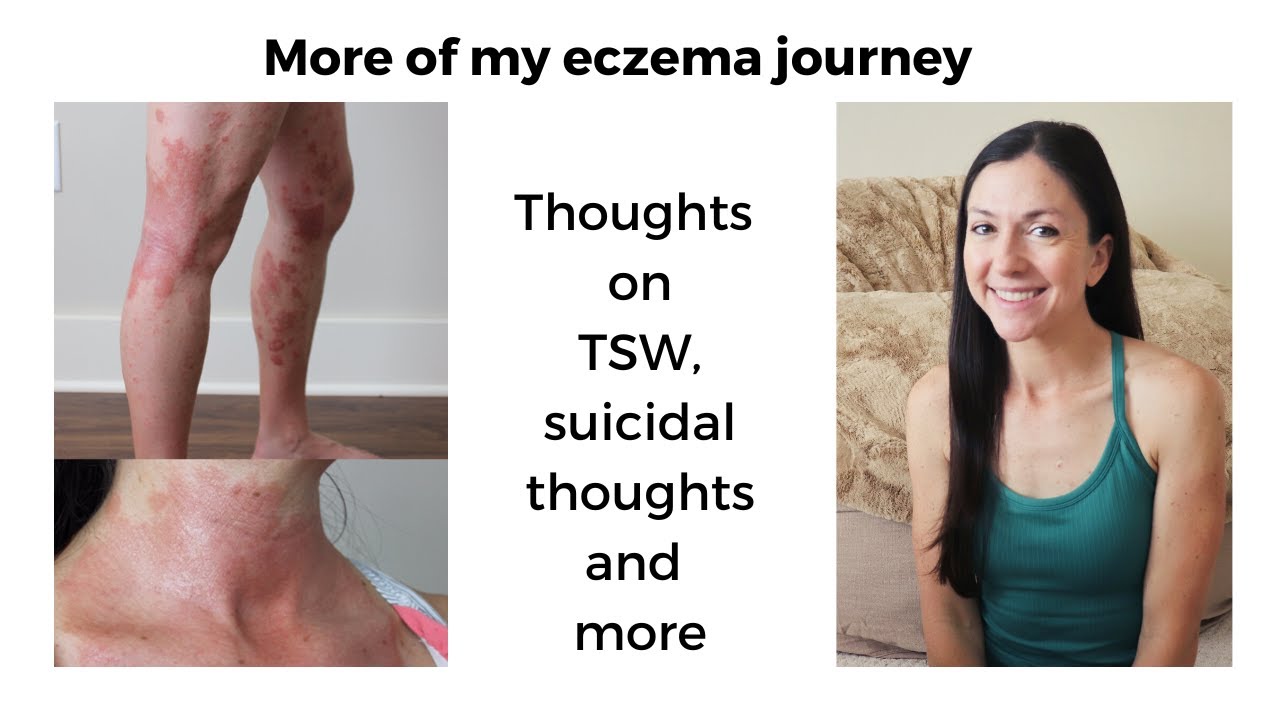 Eczema and topical steroid withdrawal (TSW) | My experience - YouTube