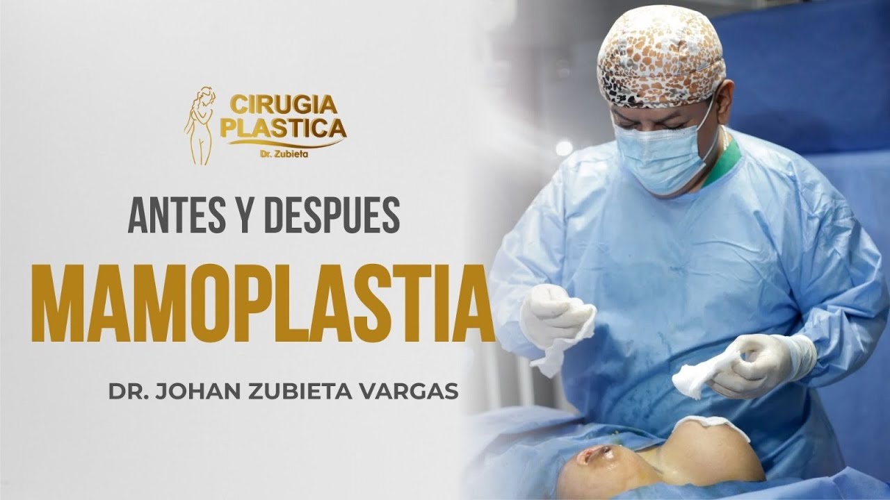 🎥 Mamoplastia Antes y Después | Resultados Reales con el Dr. Zubieta ...