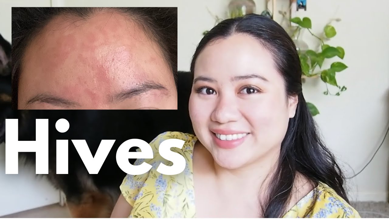Skin hives treatment at home | How I managed my hives outbreak - YouTube