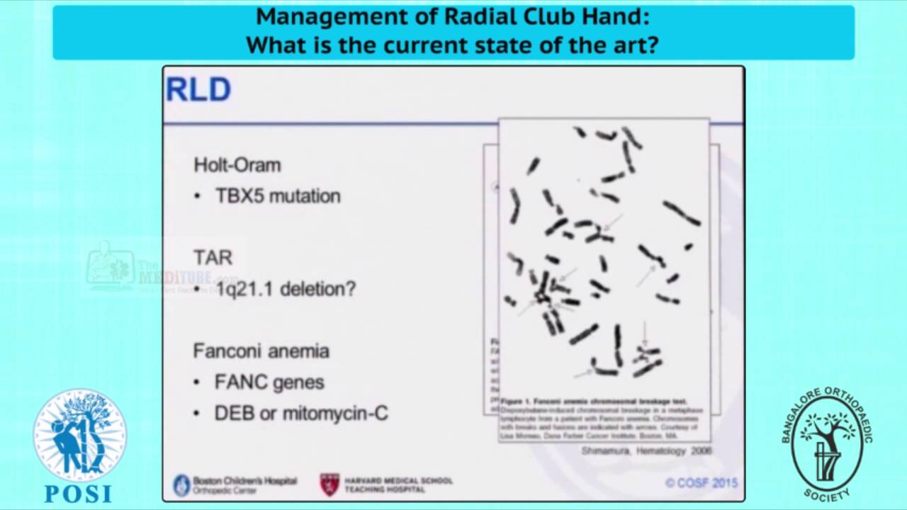 Management of Radial Club Hand: What is the current state of the art ...