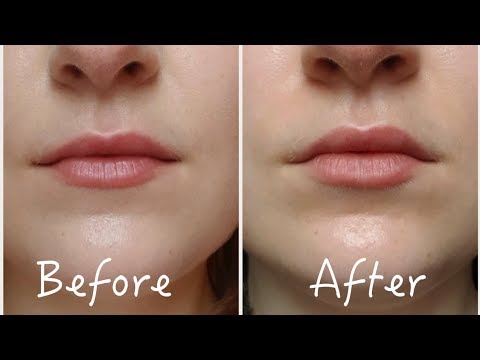 3 Ways To Permanently Enhance Lips Without Lip Injections + Before ...