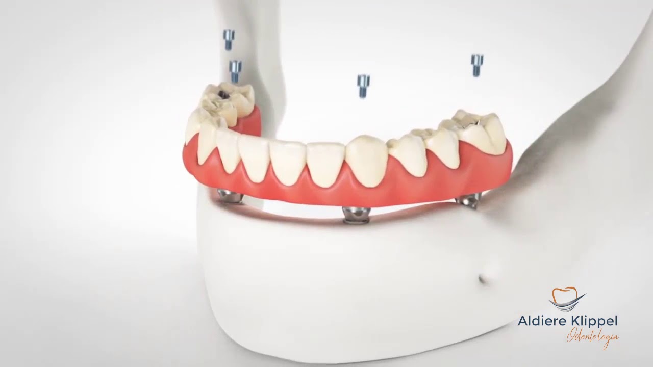 Protocolo sobre implante - YouTube