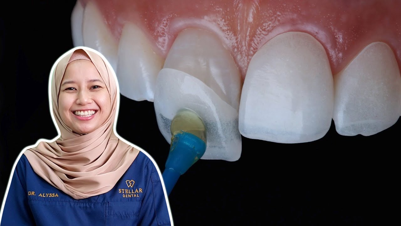 Ini Kesan Pakai Fake Veneer - YouTube